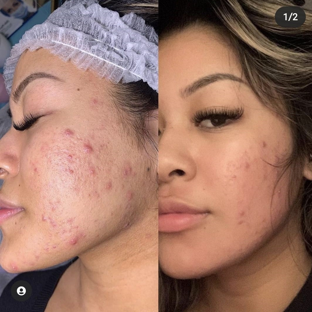 Zena Algae Peel in Vancouver - The Vancouver Aesthetician